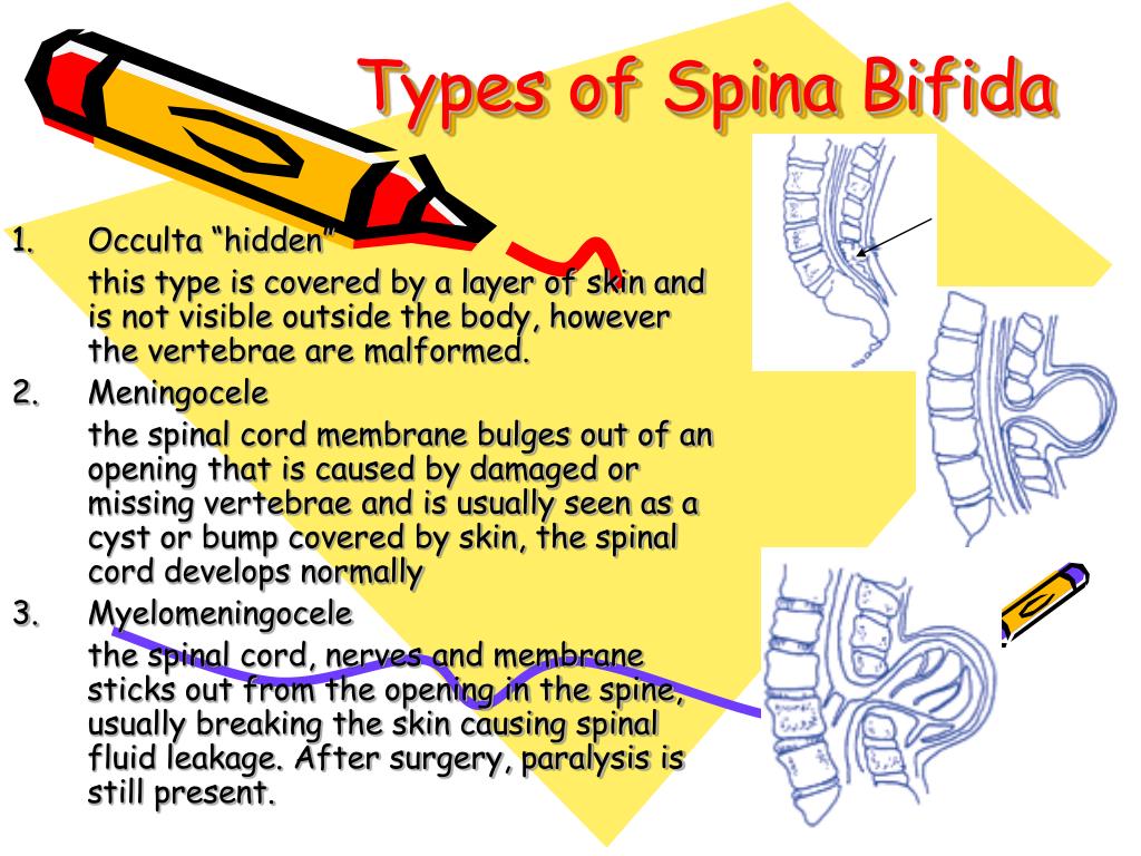 Ppt Spina Bifida Powerpoint Presentation Free Download Id 415438