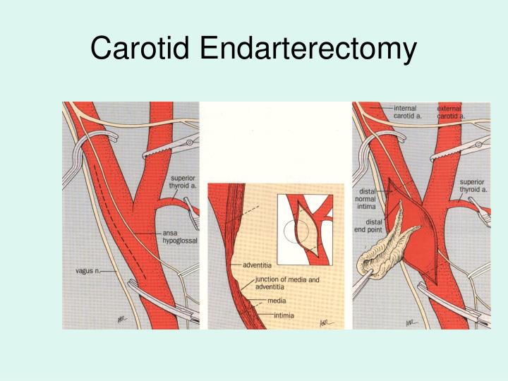 PPT - Surgical Intervention for Carotid Artery Disease PowerPoint ...