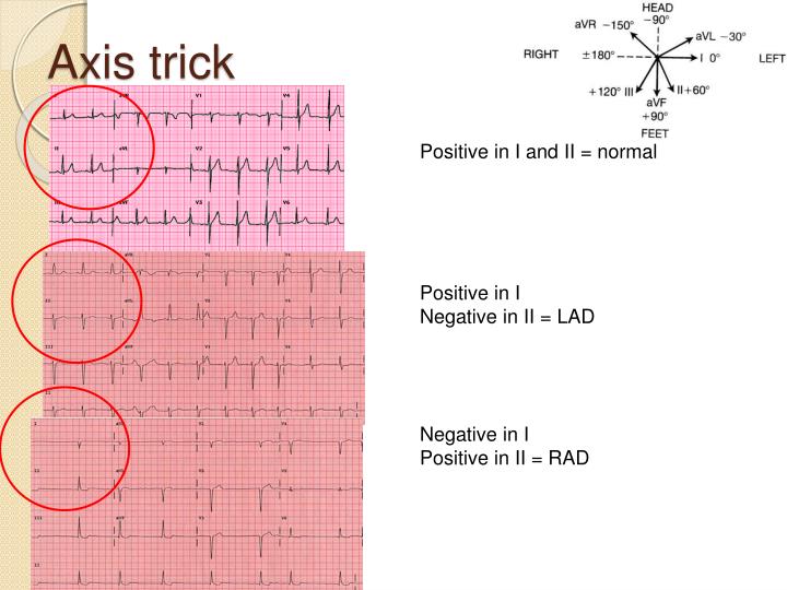 PPT - ECG interpretation for beginners - 1 PowerPoint Presentation - ID ...