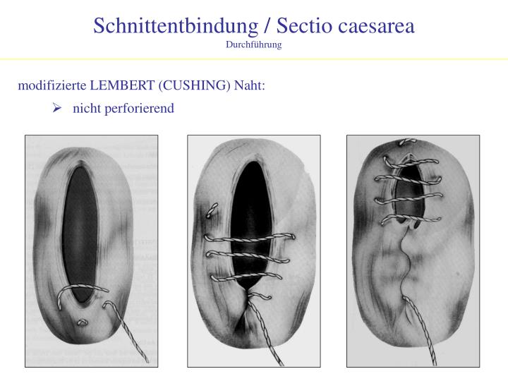 PPT - Schnittentbindung Sectio caesarea PowerPoint Presentation - ID:418552