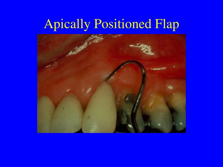 PPT - Clinical Crown Lengthening and Preprosthetic Surgery PowerPoint ...