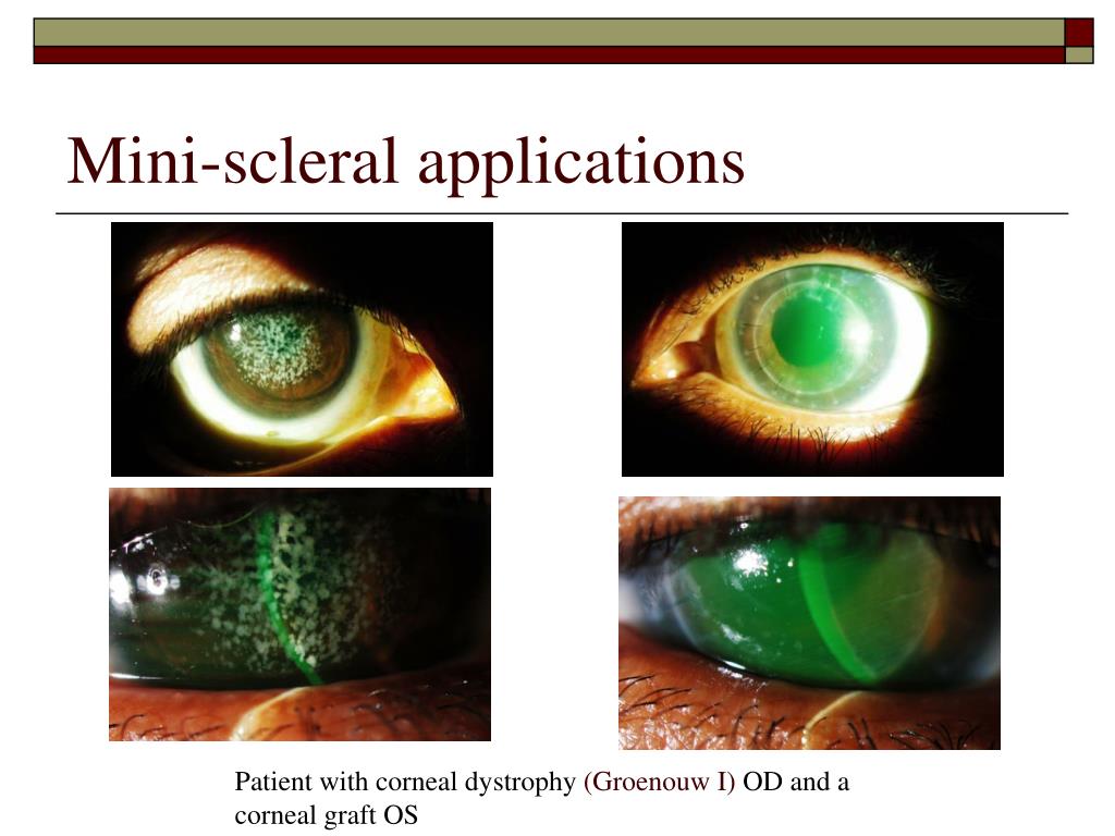 Ppt Modern Clinical Use Of Mini Scleral Contact Lenses Wco Vi
