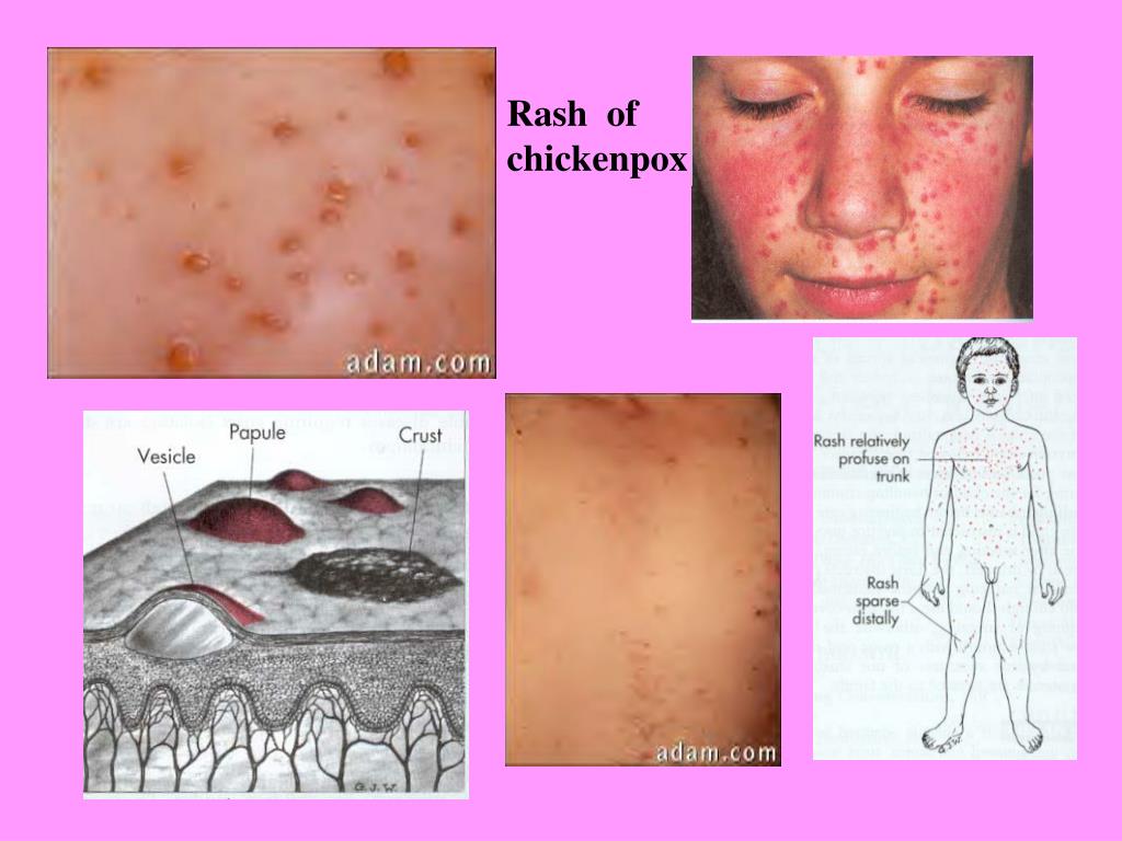 PPT - Roseola is an acute disease of infants and young children that is ...
