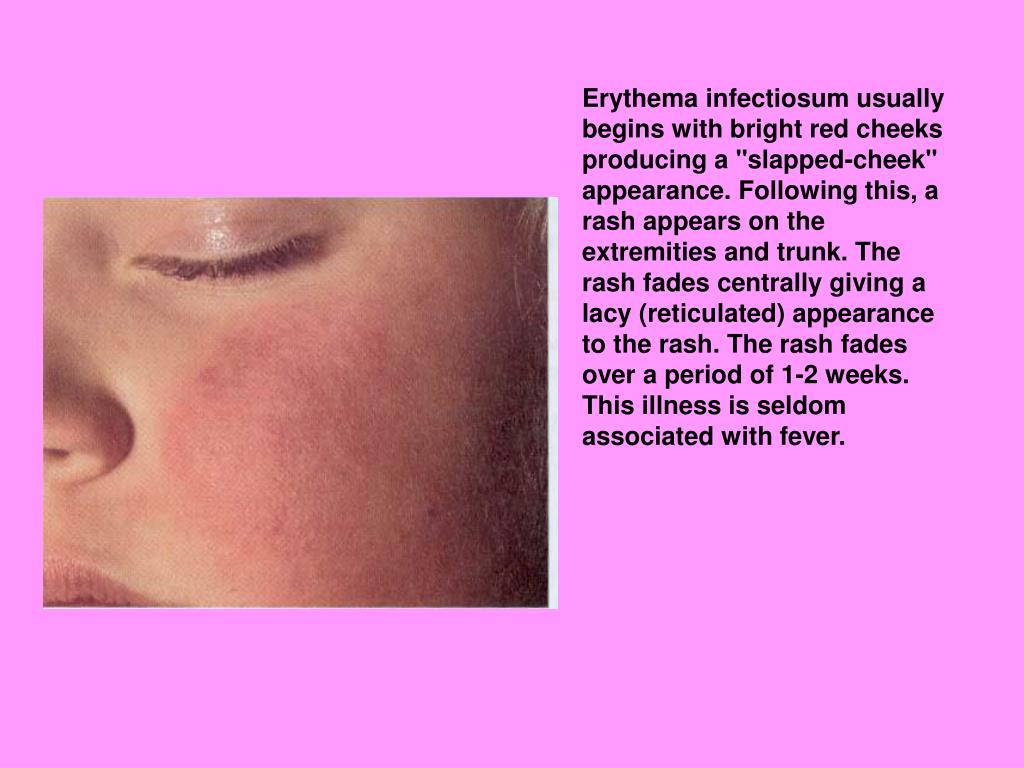 PPT - Roseola is an acute disease of infants and young children that is ...