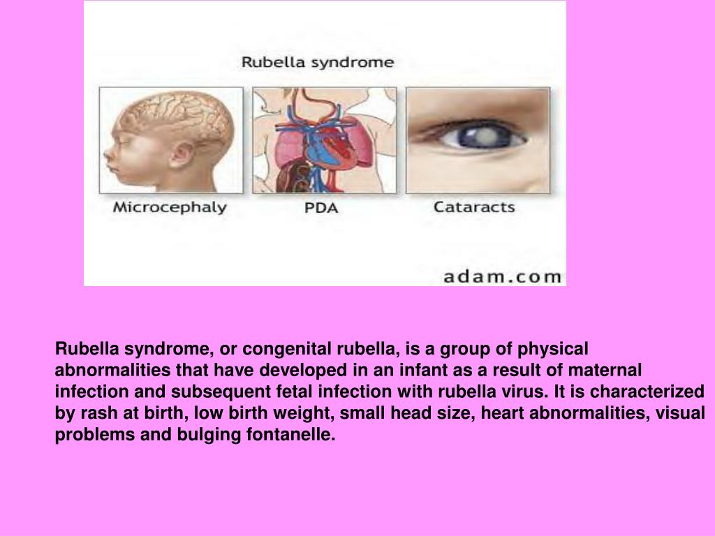 Congenital Rubella Pda