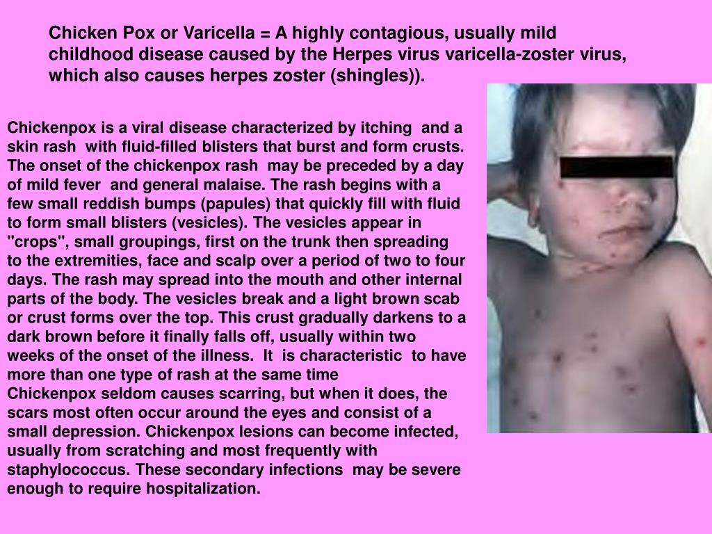 PPT - Roseola is an acute disease of infants and young children that is ...