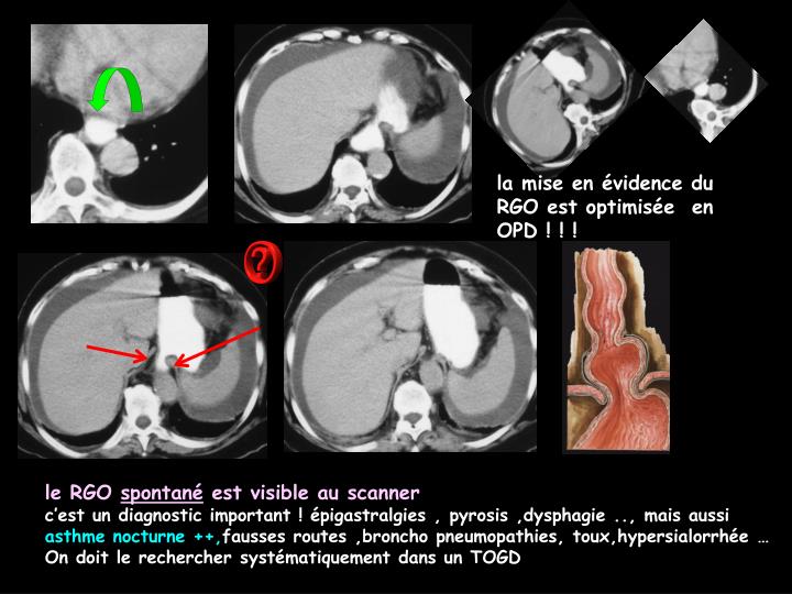 PPT - TOGD PowerPoint Presentation - ID:423799