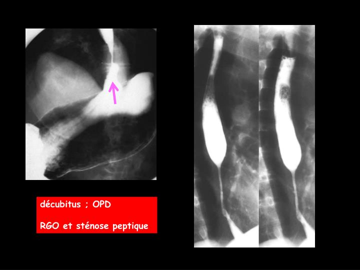 PPT - TOGD PowerPoint Presentation - ID:423799