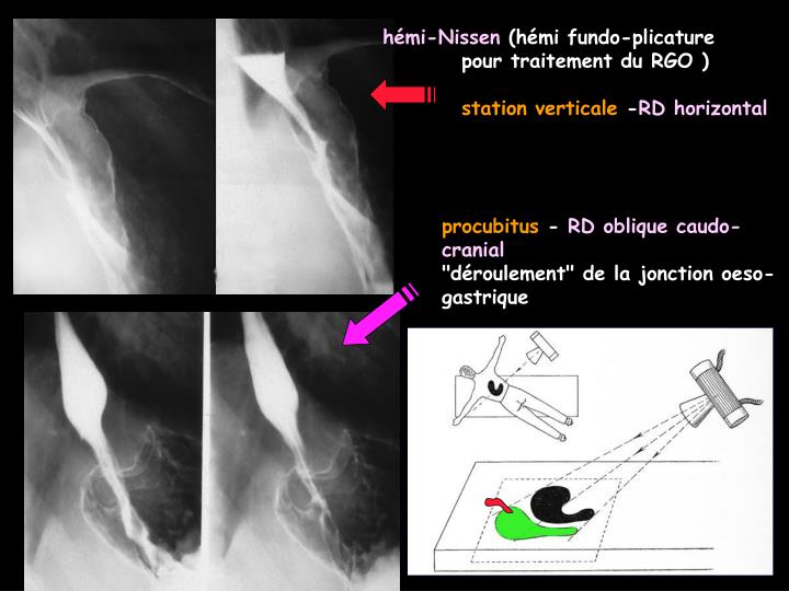 PPT - TOGD PowerPoint Presentation - ID:423799