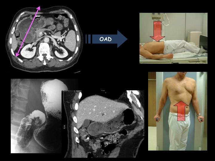 PPT - TOGD PowerPoint Presentation - ID:423799