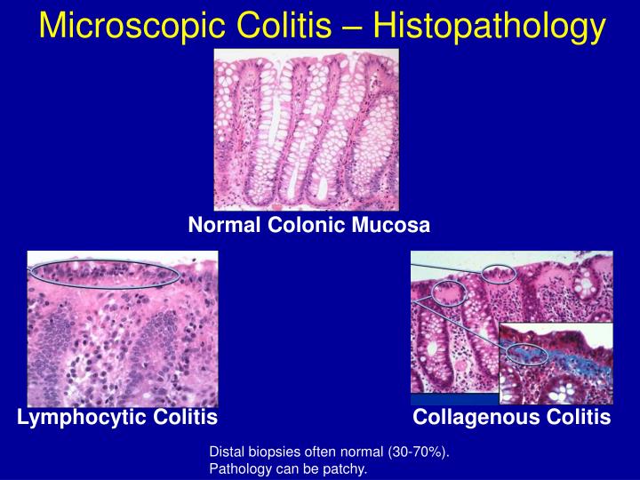 PPT - Microscopic Colitis – In 2010 A Better Defined and Common Cause ...