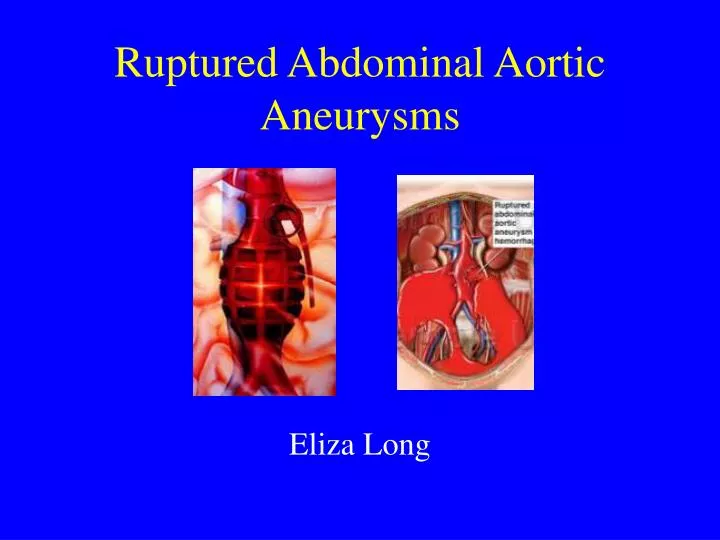 PPT - Ruptured Abdominal Aortic Aneurysms PowerPoint Presentation, free ...