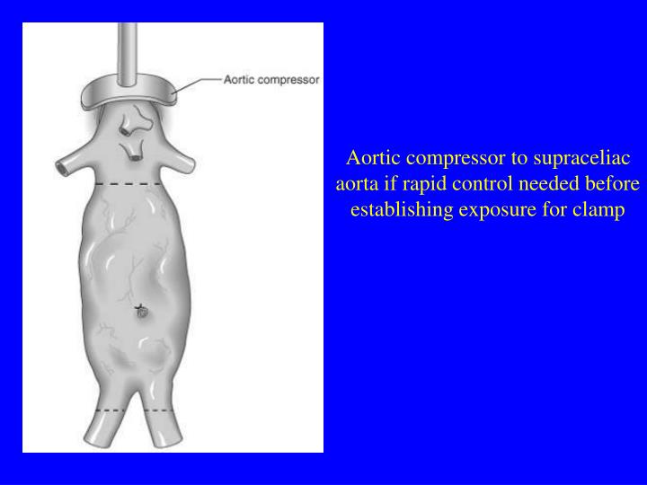 PPT - Ruptured Abdominal Aortic Aneurysms PowerPoint Presentation - ID ...