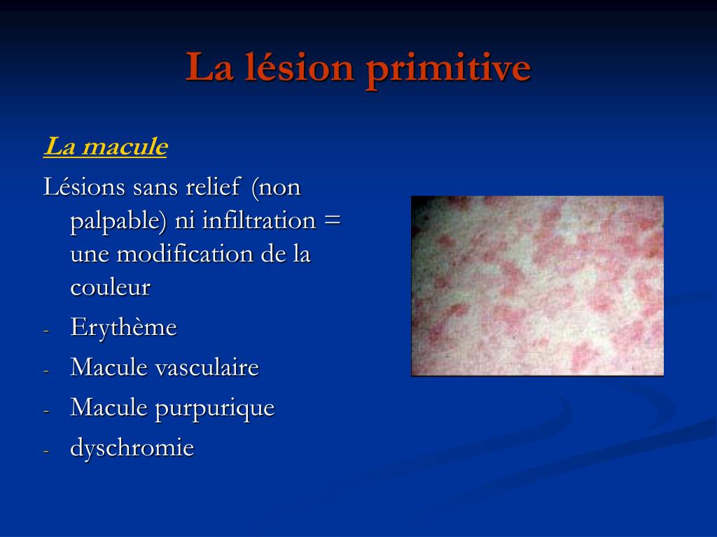 PPT - Les lésions élémentaires en dermatologie PowerPoint Presentation ...