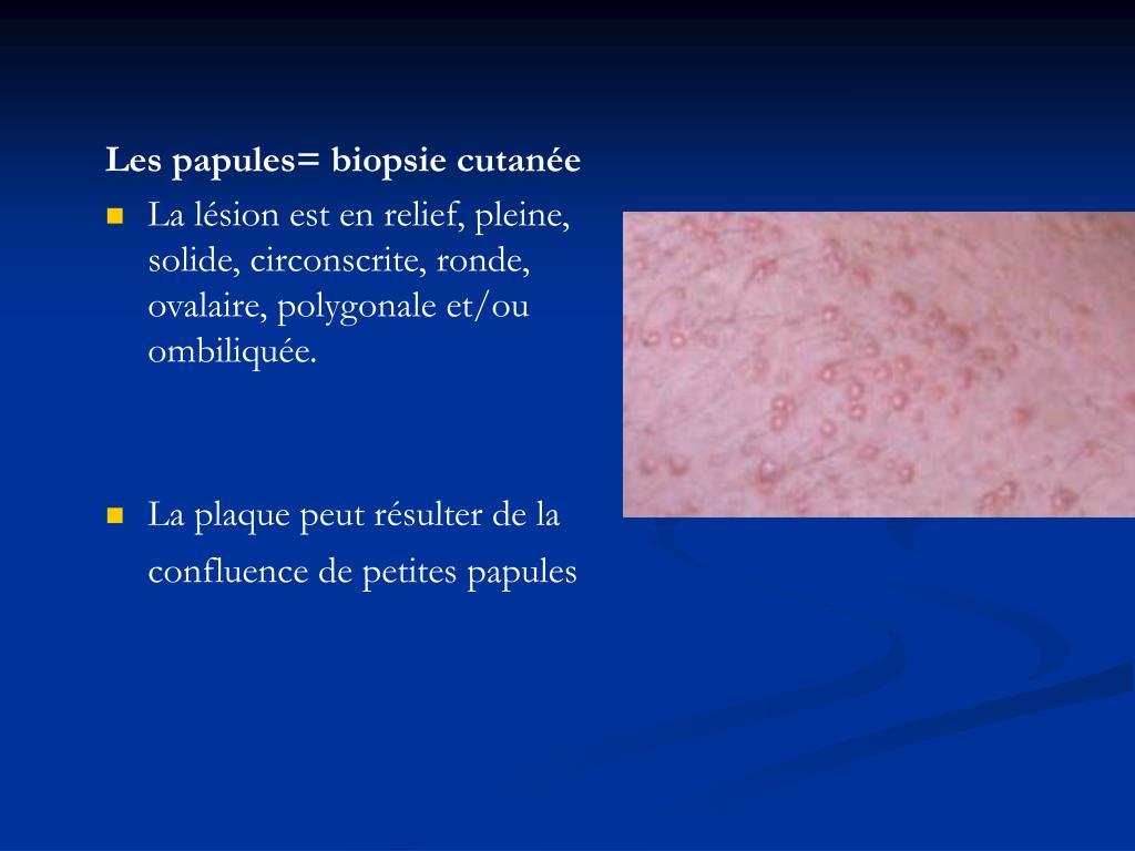 PPT - Les lésions élémentaires en dermatologie PowerPoint Presentation ...