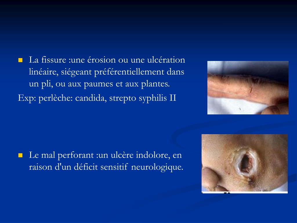 PPT - Les lésions élémentaires en dermatologie PowerPoint Presentation ...