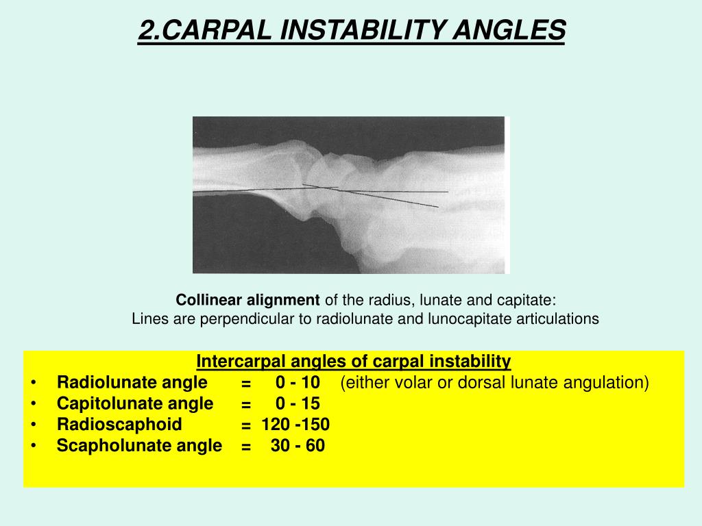Ppt Igo Goldberg M D Hand Surgeon Tel Aviv Israel Powerpoint