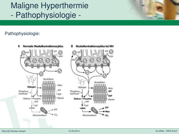 PPT - Maligne Hyperthermie - The Ugly - PowerPoint Presentation - ID:429733