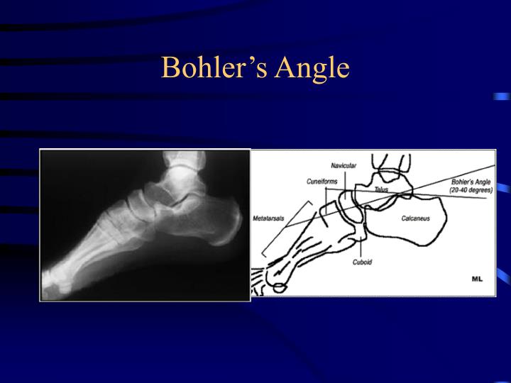 PPT - Radiology of the Foot PowerPoint Presentation - ID:430607