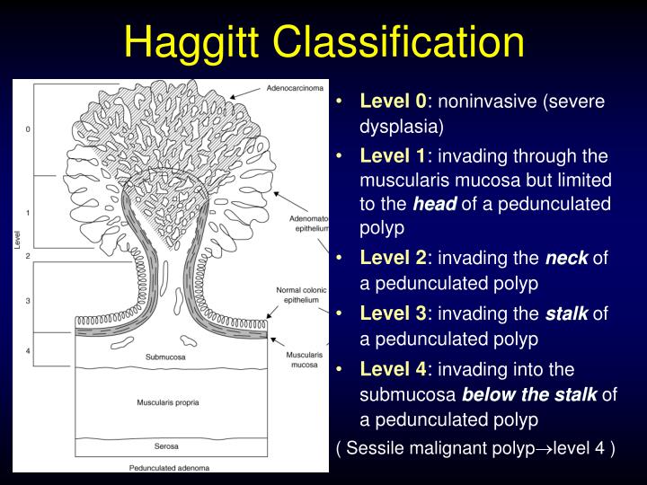 PPT - Malignant Rectal Polyp PowerPoint Presentation - ID:432580