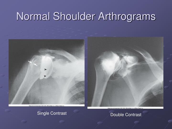 PPT - Arthrography PowerPoint Presentation - ID:443478