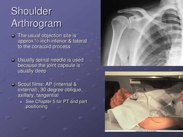 PPT - Arthrography PowerPoint Presentation - ID:443478