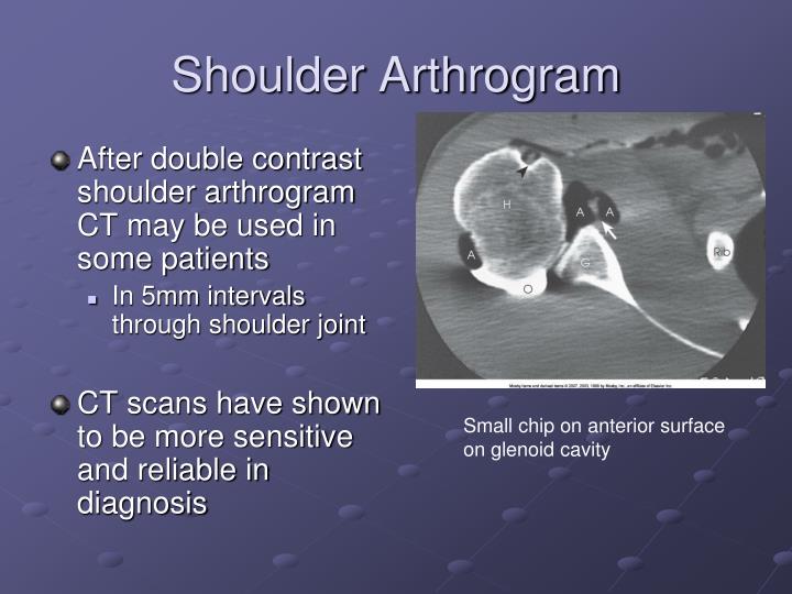 PPT - Arthrography PowerPoint Presentation - ID:443478