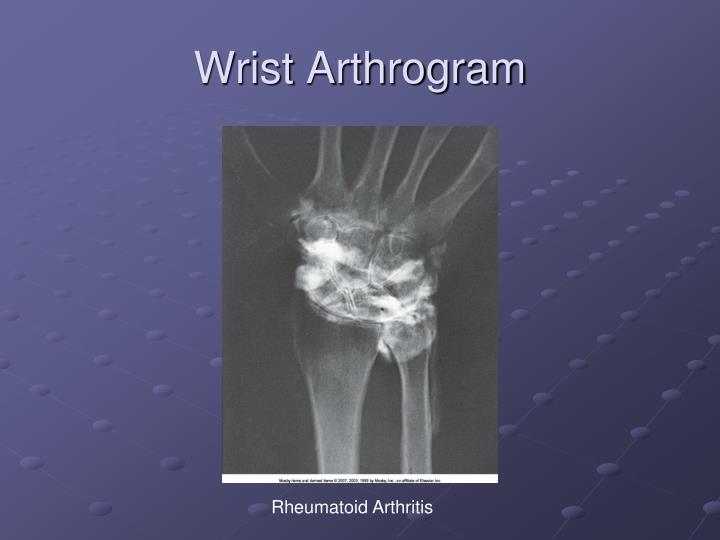 PPT - Arthrography PowerPoint Presentation - ID:443478