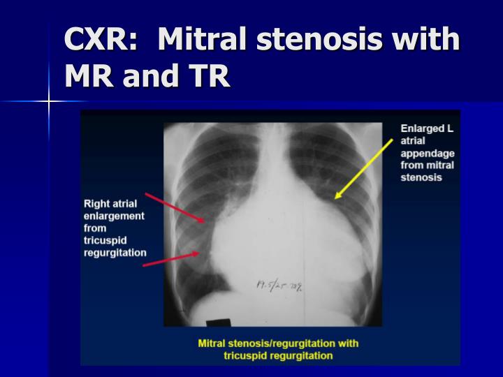 PPT - Valvular Heart Disease PowerPoint Presentation - ID:443921