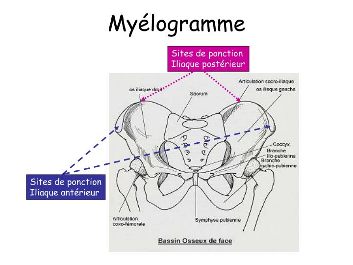 PPT - Myélogramme et Biopsie Ostéo-Médullaire PowerPoint Presentation ...