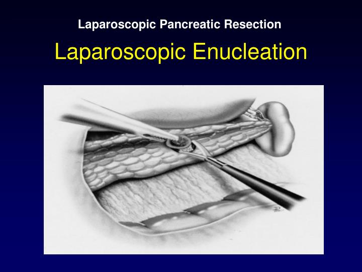 PPT - Laparoscopic Pancreatectomy PowerPoint Presentation - ID:447449