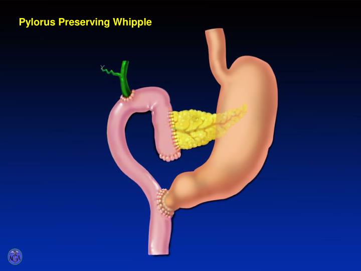 PPT - Laparoscopic Pancreatectomy PowerPoint Presentation - ID:447449