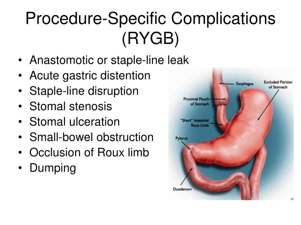 PPT - Post-Surgical Care of the Bariatric Patient PowerPoint ...