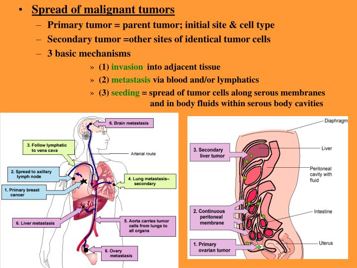 PPT - Neoplasms PowerPoint Presentation - ID:455689
