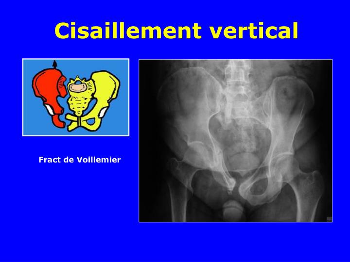 PPT - Fractures du bassin PowerPoint Presentation - ID:456006