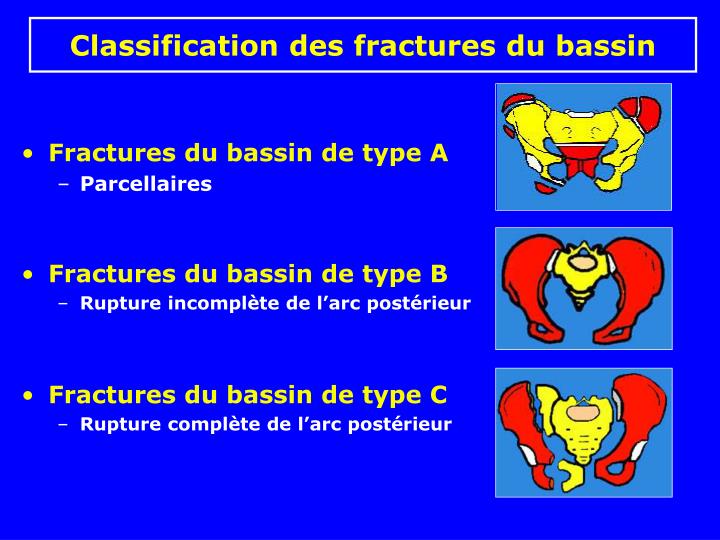 PPT - Fractures du bassin PowerPoint Presentation - ID:456006