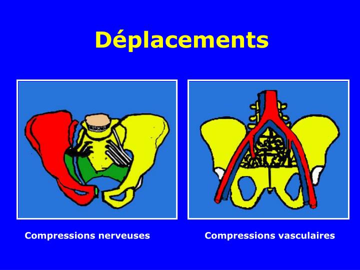 PPT - Fractures du bassin PowerPoint Presentation - ID:456006