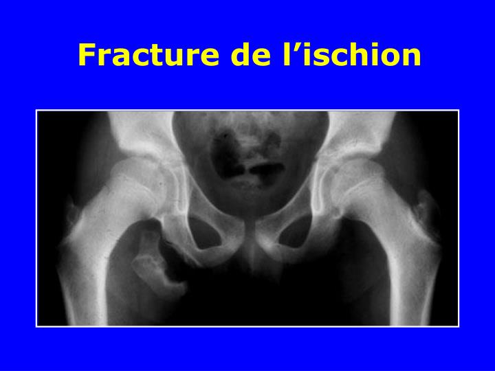 PPT - Fractures du bassin PowerPoint Presentation - ID:456006