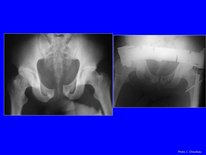 PPT - Fractures du bassin PowerPoint Presentation - ID:456006