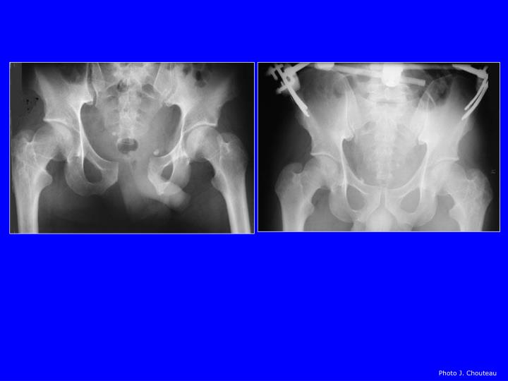 PPT - Fractures du bassin PowerPoint Presentation - ID:456006