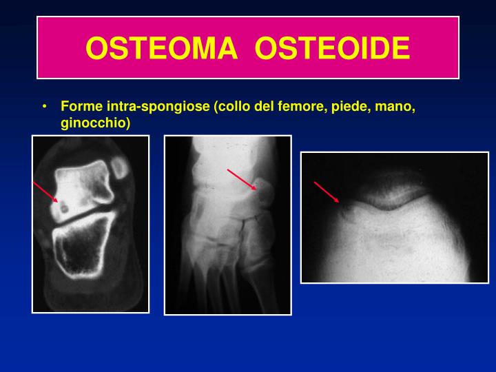 PPT - OSTEOMA OSTEOIDE PowerPoint Presentation - ID:457946