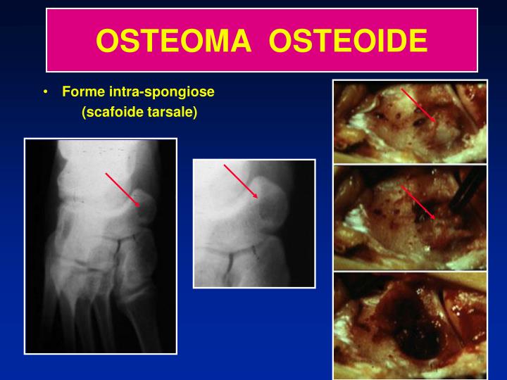 PPT - OSTEOMA OSTEOIDE PowerPoint Presentation - ID:457946