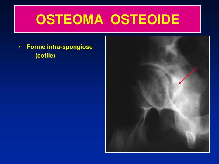 PPT - OSTEOMA OSTEOIDE PowerPoint Presentation - ID:457946