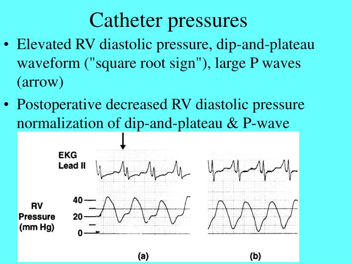 PPT - Constrictive Pericarditis PowerPoint Presentation - ID:459191