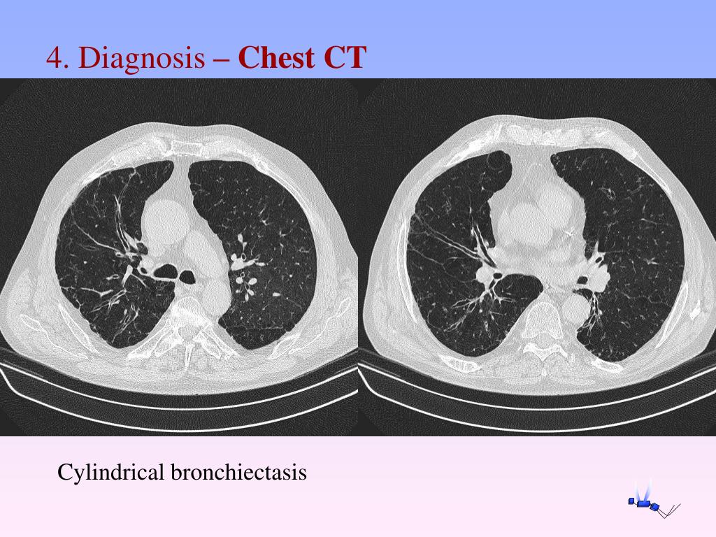 PPT - Clinical manifestation and diagnosis of bronchiectasis Aleš ...