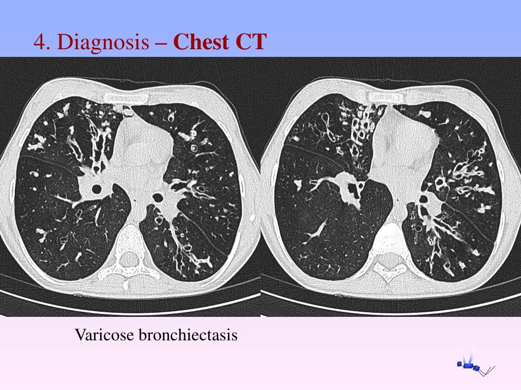 PPT - Clinical manifestation and diagnosis of bronchiectasis Aleš ...