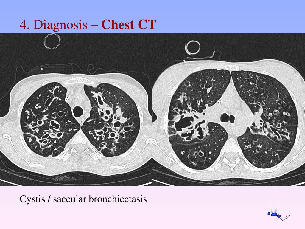 PPT - Clinical manifestation and diagnosis of bronchiectasis Aleš ...