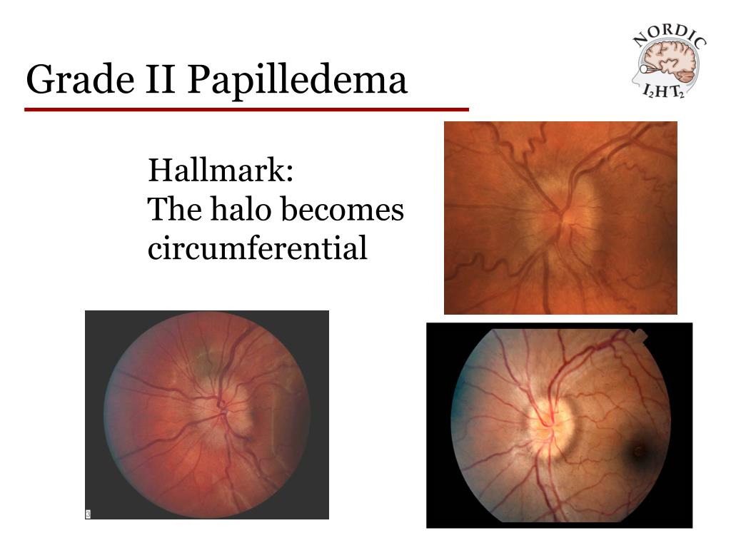 PPT - Idiopathic Intracranial Hypertension Treatment Trial Modified ...