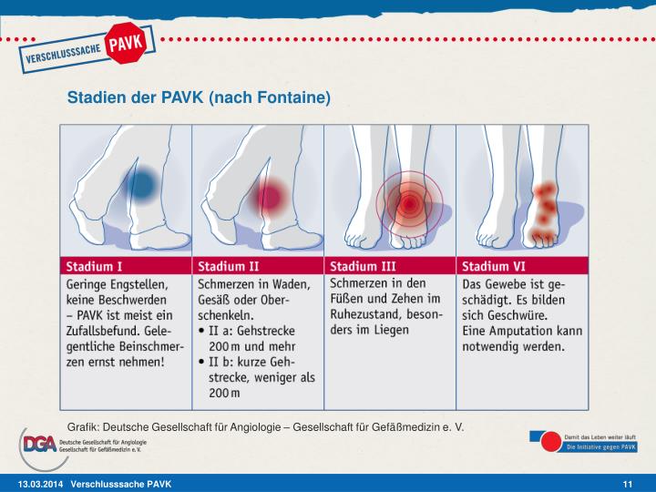 PPT - PAVK periphere arterielle Verschlusskrankheit PowerPoint ...