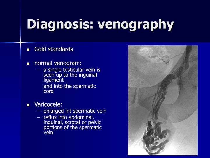 PPT - Testicular varicoceles PowerPoint Presentation - ID:463676